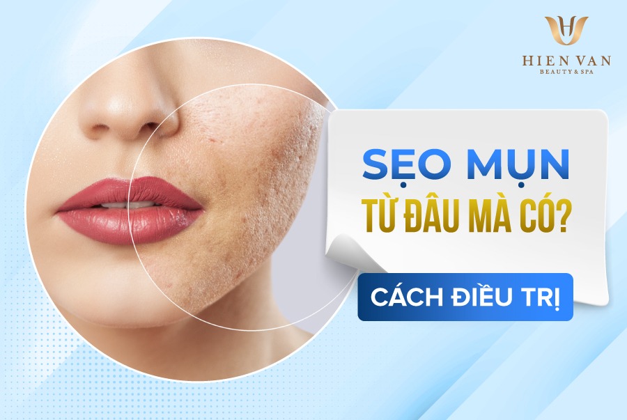 Sẹo mụn từ đâu mà có? Cách điều trị sẹo mụn hiệu quả với Phòng Khám Da ...