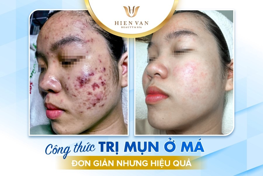 Trị mụn ở má: top 5 công thức trị mụn ở má đơn giản nhưng hiệu quả cao