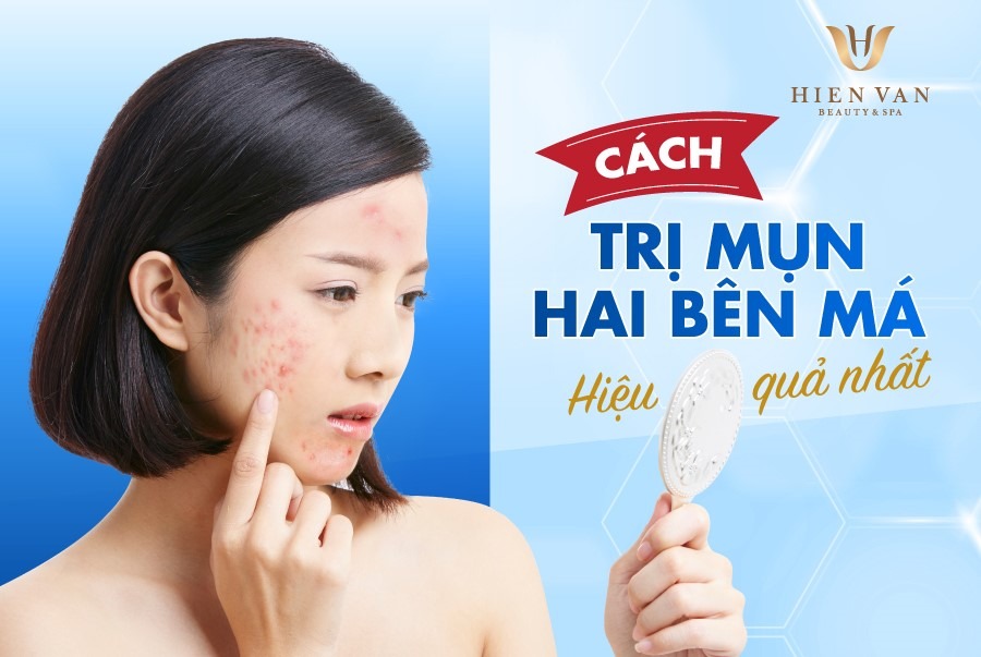 #1 Cách trị mụn hai bên má đạt hiệu quả cao bằng khoa